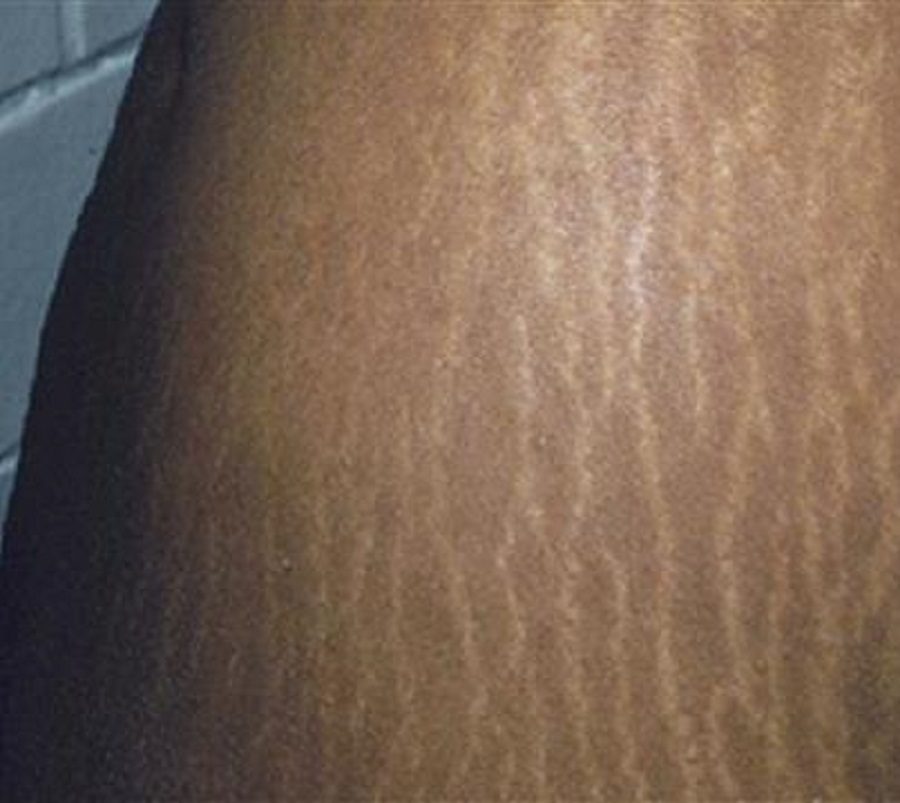 Four Reasons You should Embrace Your Stretch Marks | The Guardian ...