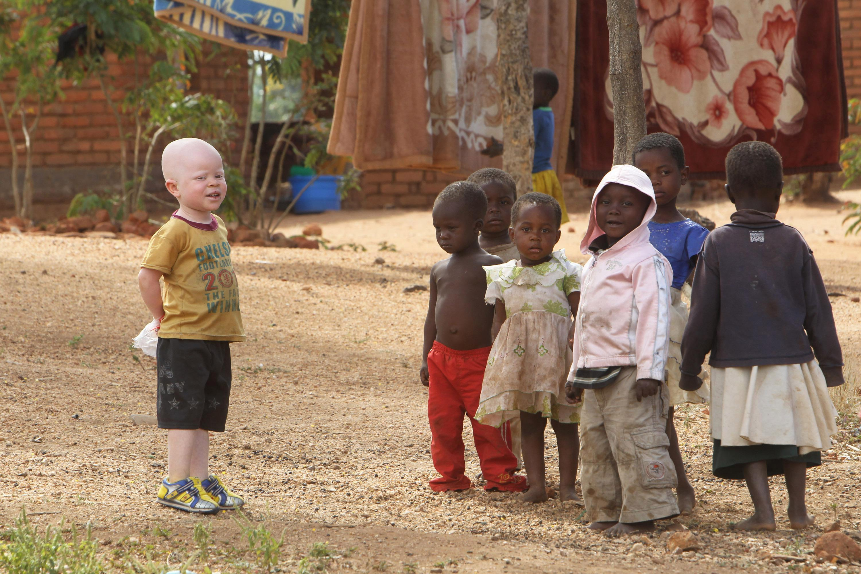 What You Need To Know About Albinism