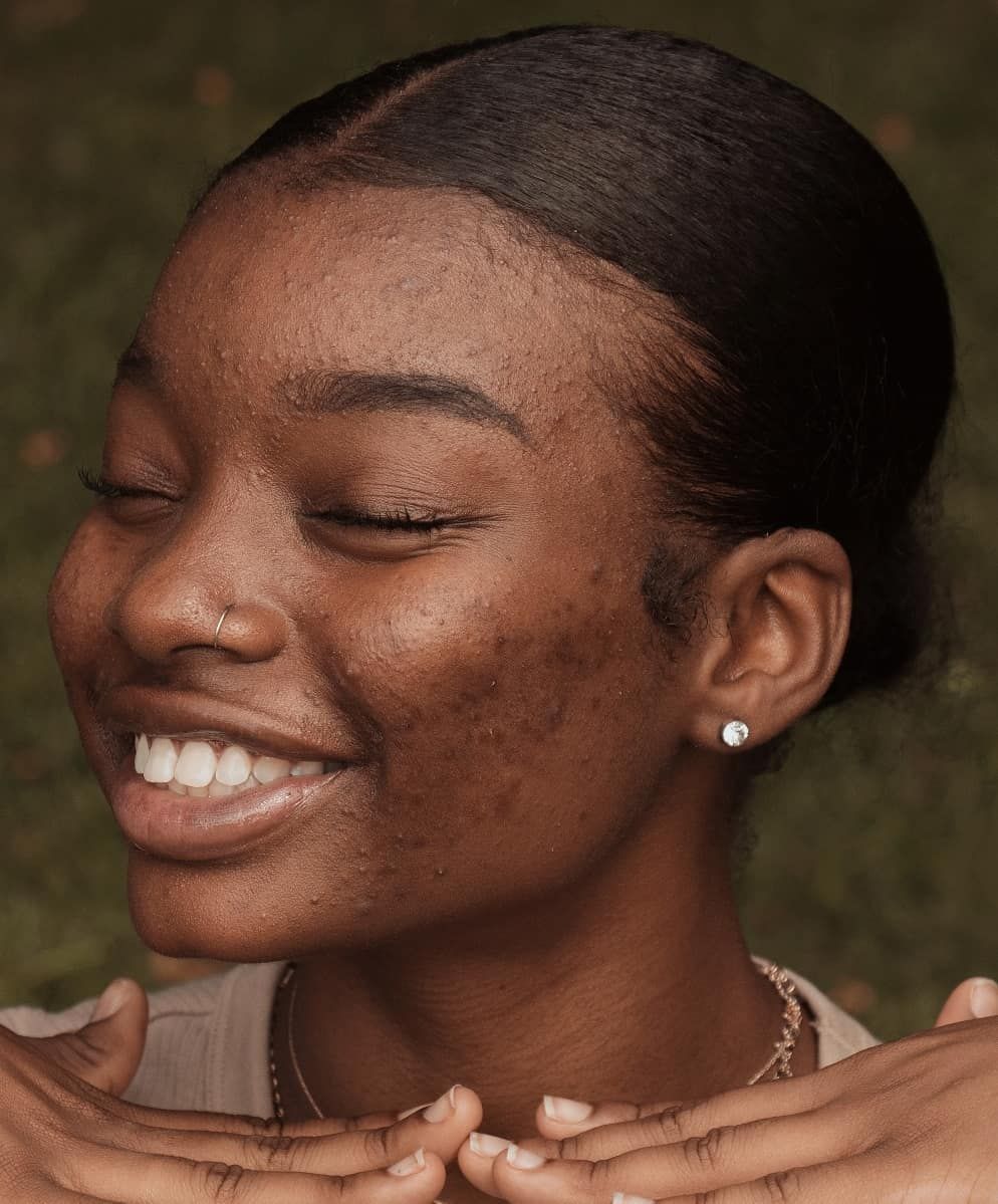 What The Pimple On Your Face Is Trying To Tell You