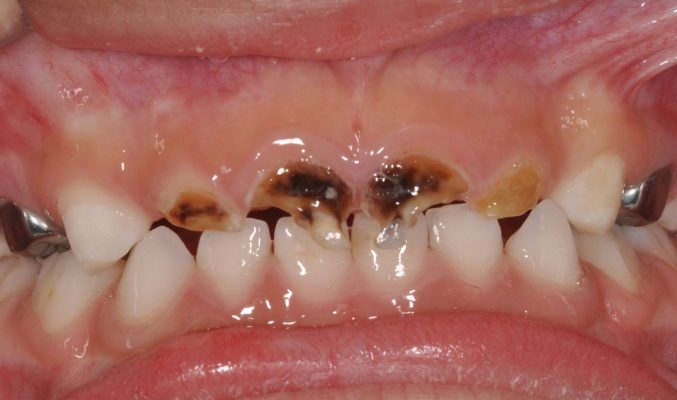 Experts decry high prevalence of untreated dental caries